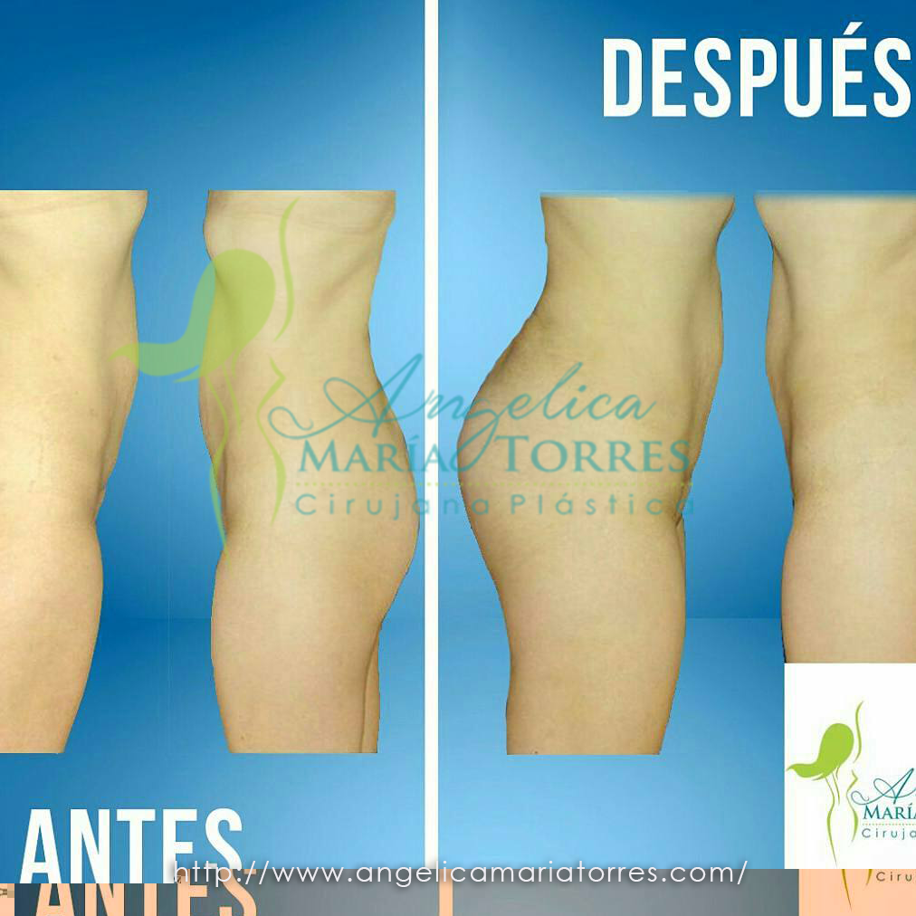Trabajos Realizados – Angelica Maria Torres Cirujano Plástico